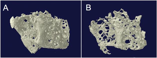 Dissolving bone to ease pain | Research | Chemistry World