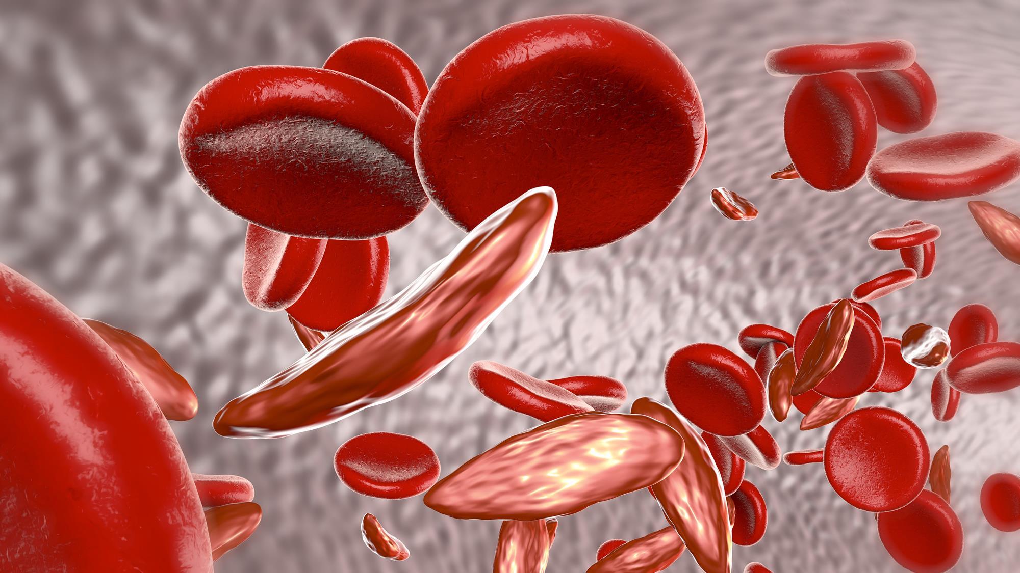 FDA approves first sickle cell drug in almost two decades | Business ...